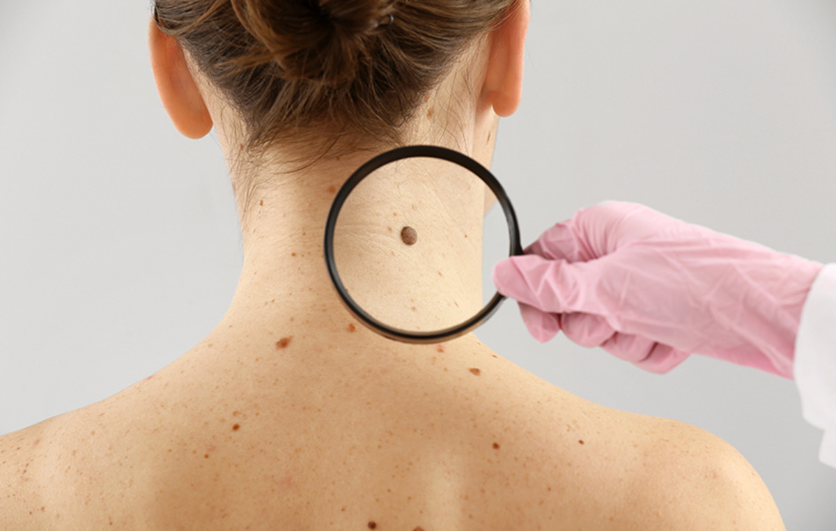 Καρκίνος του δέρματος: Τα συμπτώματα και τα σημάδια που θέλουν προσοχή ...