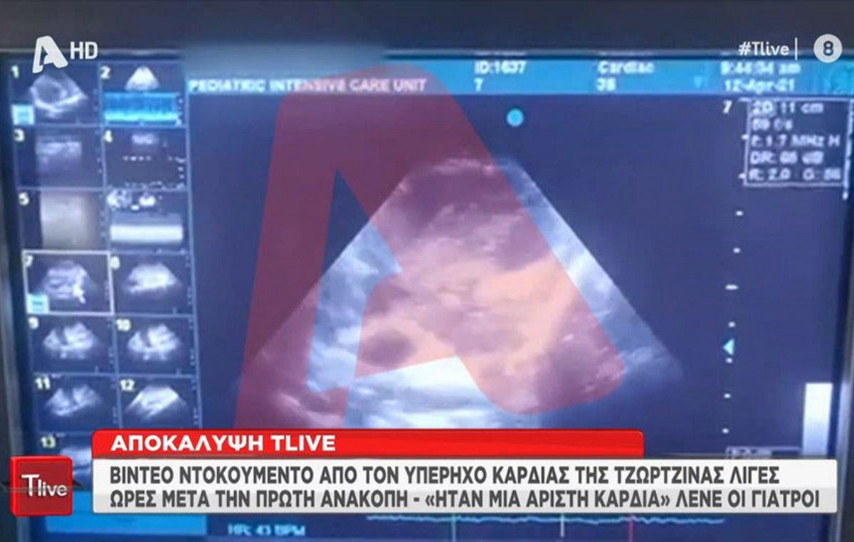 Ρούλα Πισπιρίγκου: Βίντεο – ντοκουμέντο με τον υπέρηχο της καρδιάς της ...